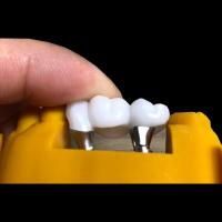 China Implant Dental Lab | Silver Custom Titanium Abutments Dental Implants With Full Zirconia Crown for sale
