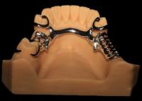 China China Dental Lab Outsourcing  | High Strength 3D Printed Argen Dental Framework With Clear Clasps for sale