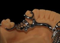 China China Dental Lab Outsourcing  | High Strength 3D Printed Argen Dental Framework With Clear Clasps for sale