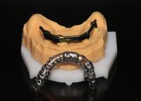 China Class 5 All On 4 AOX Implants With Hybrid Titanium Bar / Clips / Metal Mesh / Full Denture for sale