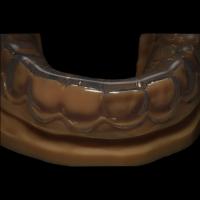 China Digital Dental Lab | Clear Soft Night Guard Occlusal Splint Breathability Heavy Duty Protection for sale