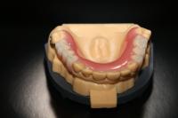 China How Much Does A Flexible Denture Cost | Heat Curing Acrylic Dentures Lucitone 199 Impact Resistant for sale