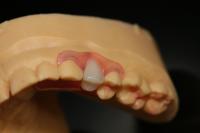 China Flexible Partial Denture Lab | Natural Look TCS Flexible Denture Stain Resistant BPA Free for sale