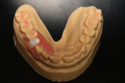 China Natural Look TCS Flexible Denture Stain Resistant BPA Free for sale