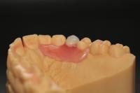 China Flexible Partial Denture Lab | Natural Look TCS Flexible Denture Stain Resistant BPA Free for sale