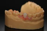 China Flexible Partial Denture Lab | Natural Look TCS Flexible Denture Stain Resistant BPA Free for sale