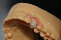 China Flexible Partial Denture Lab | Natural Look TCS Flexible Denture Stain Resistant BPA Free for sale