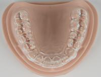 China Digital Dental Solutions Lab | Dental Hard Occlusal Splint 1-3mm For Jaw Pain Relief Protection Oral for sale