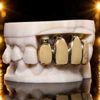 China Digital full metal crown CAD CAM - Custom Gold Open-Faced Crown for sale