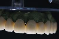 China CE & ISO certified dental prosthesis—Natural‑Esthetic Full Zirconia Bridge for sale