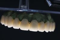 China CE & ISO certified dental prosthesis—Natural‑Esthetic Full Zirconia Bridge for sale