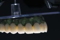 China CE & ISO certified dental prosthesis—Natural‑Esthetic Full Zirconia Bridge for sale