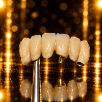 China Dental Lab Custom Implant Bridge — Implant Retained Porcelain Fused Metal Bridge for sale
