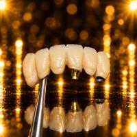 China Dental Lab Custom Implant Bridge — Implant Retained Porcelain Fused Metal Bridge for sale
