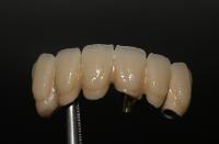 China Dental Lab Custom Implant Bridge — Implant Retained Porcelain Fused Metal Bridge for sale