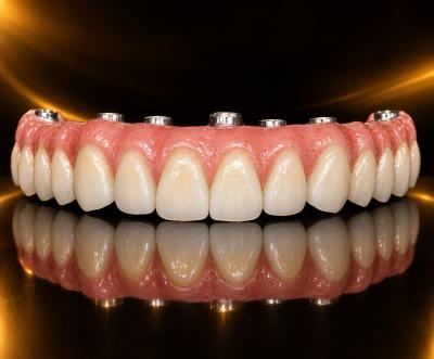 China ADL Dental Iaboratories limited | Class I AOX Implants All On 4 Hybrid Titanium Screw Retained Full Zirconia for sale