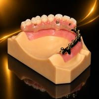 China Dental Implant Laboratory | Class 3 Milled Titanium Bar All On X Dental Lmplants With Full Acrylic Denture for sale
