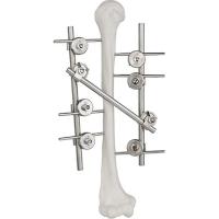 China Titanium Humeral External Fixation Device Orthopedic Surgical Implant for sale
