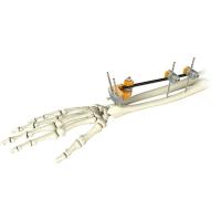 China Medical Orthopedic Ulna Distal Radius Fracture External Fixation for sale