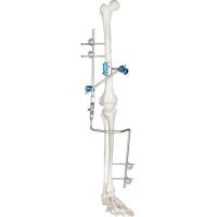China Medical Knee Joint External Fixation Device Orthopedic Surgical Instruments for sale