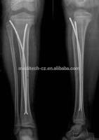 China Orthopedic Implants TEN Titanium Elastic Nail For Children Surgery for sale