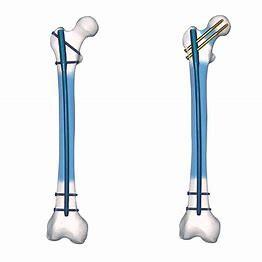 China Precice Ti Alloy Surgery Interlocking Nail Femur Mechanical Stable for sale