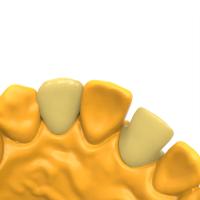China Biocompatible Permanent Crown Bridge Resin Hot Deformation Temperature 80C Bending Strength 180-208 Mpa for sale