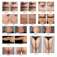 China Microneedling Vmax Vaginal 3.0mm 4.5mm Hifu 4d Ultra Vmax Machine 200W for sale