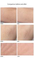 China Semiconductor Permanent Epilation 808nm Diode Hair Removal Laser Machine for sale
