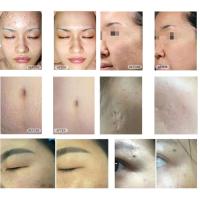 China Fotona 4D CO2 Fractional Laser Machine Erbium Laser 1550nm Acne Laser Machine for sale