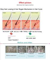 China 650nm Galvanic Nti Hair Growth Therapeutic Laser Hair Growth Machine 50Hz for sale