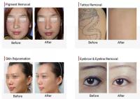 China Tattoo Removal Picosecond Laser Machine 755nm 1064nm 1320nm for sale