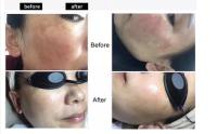 China 755nm Mole Picosecond Laser Machine Co2 Laser Freckle Removal for sale
