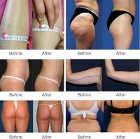 China 80k 6 In 1 Laser Lipo Cavitation Machine With Lipo Laser 650nm for sale