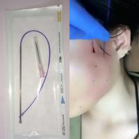China PDO Thread Hyaluronic Acid Dermal Filler Non Surgical Thread Lift 30g 29g 25mm for sale