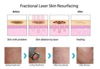 China Ultra Pulse CO2 Fractional Laser Machine 10600nm CO2 Laser Resurfacing for sale