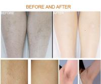 China 808 Diode Laser Hair Removal Picosecond Laser Machine 10-160J/Cm2 for sale