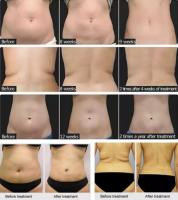 China Rf Ultrasound Weight Loss Slimming 7D 9D HIFU Btl Exilis Machine for sale