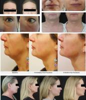 China Ultrasonic Focus HIFU Facial 7D Machine Professional Anti Aging Skin Tightening for sale