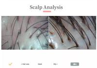 China 3 Spectrum Scalp Analyzer Detector Portable Scalp Hair Follicle 720P 1080P for sale