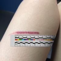 China Self Adhesive Wound Ruler 10cm Medical Tape Measure for Nurses Documentation for sale