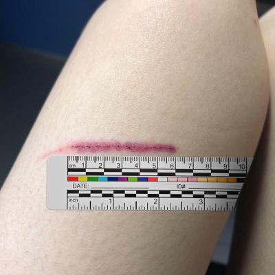 China Self Adhesive Wound Ruler 10cm Medical Tape Measure for Nurses Documentation for sale