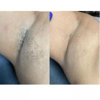 China Nd Yag Diode Laser Painless Hair Removal Machine 1064nm 532nm 1320nm 808nm for sale