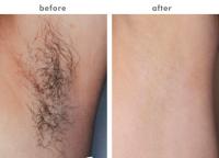 China Salon 808nm Laser Hair Removal Device With Efficient Skin Cooling System for sale
