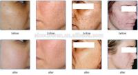 China Photobiology PDT LED Light Therapy Machine Skin Rejuvenation High Efficiency for sale