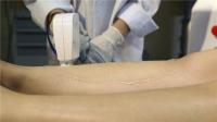 China Stationary Professional 808nm Diode Laser Hair Removal Machine Max 120J/Cm2 for sale