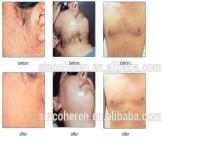 China Professional IPL Skin Rejuvenation Machine , Intense Pulsed Light Hair Removal Machine for sale