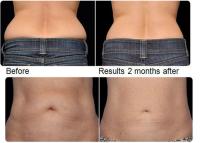 China Fat Freeze Slimming Machine For Body Sculpture / Weight Reduction for sale