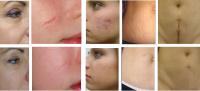 China Long Flexible Arm Vertical Type Fractional Co2 Laser Treatment For Acne Scars for sale