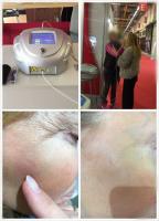 China Portable Pulser Laser Therapy Equipment , 980nm Spider Vein Removal Machine for sale